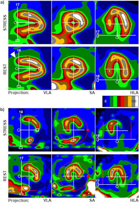 Higher processing repeatability of myocardial flow reserve calculated using net retention model ...