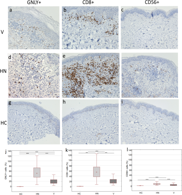 Analysis of granulysin expression in vitiligo and halo-nevus ...