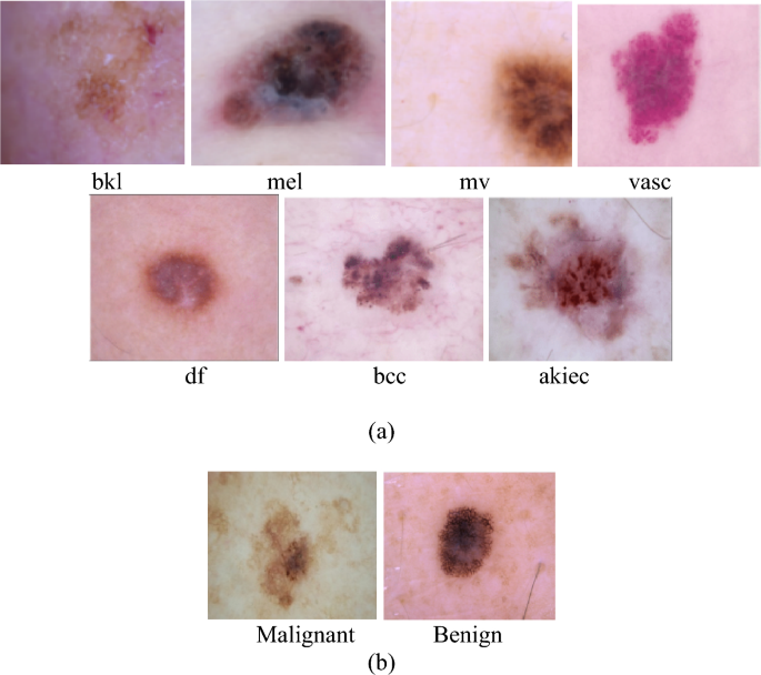 Skin cancer detection through attention guided dual autoencoder ...