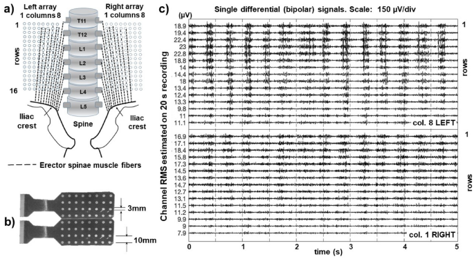 Right-left sEMG burst synchronization of the lumbar erector spinae ...