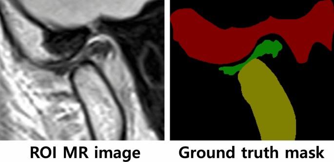 Multi-class segmentation of temporomandibular joint using ensemble deep learning | Scientific ...
