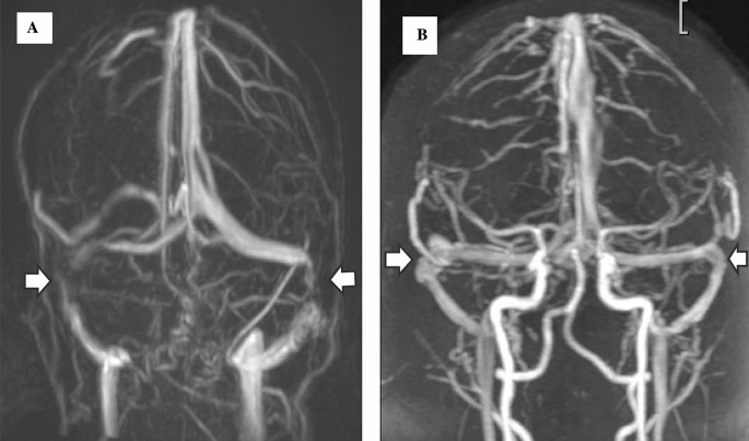 Radiological signs supporting idiopathic intracranial hypertension in ...