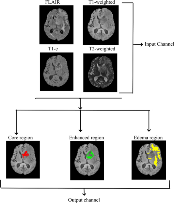Accurate low and high grade glioma classification using free water eliminated diffusion tensor ...