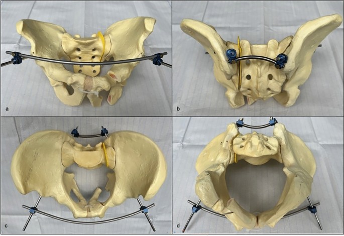 Biomechanical evaluation of an experimental internal ring fixator ...