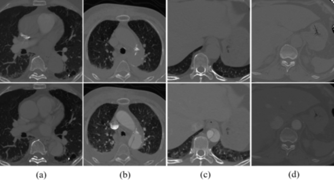 Multi-stage cascade GAN for synthesis of contrast enhancement CT aorta ...