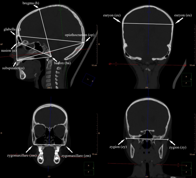 Development of maxillary sinuses in relation to the development of ...