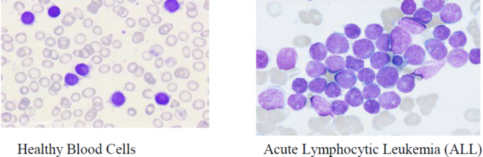 A hybrid detection model for acute lymphocytic leukemia using support ...