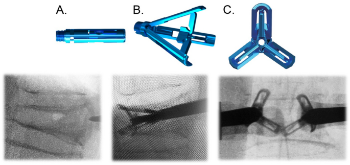 Tripod-Fix device for the treatment of painful osteoporotic vertebral ...