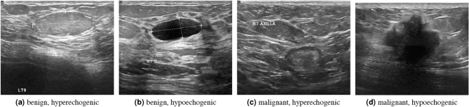 Breast tumor segmentation in ultrasound using distance-adapted fuzzy ...
