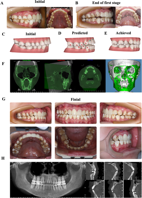Effectiveness of palatal anchorage device (PAD) for maxillary anterior ...