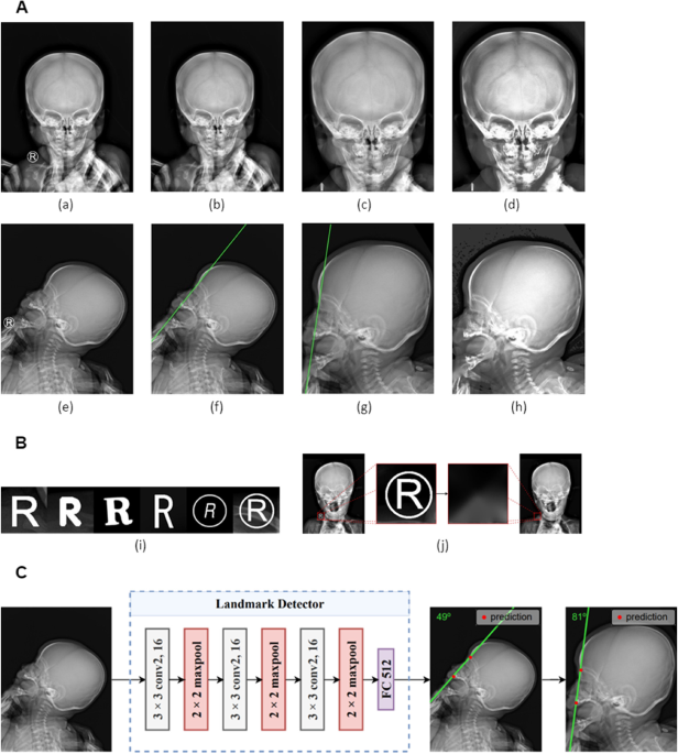 Convolutional neural network-based classification of craniosynostosis and suture lines from ...