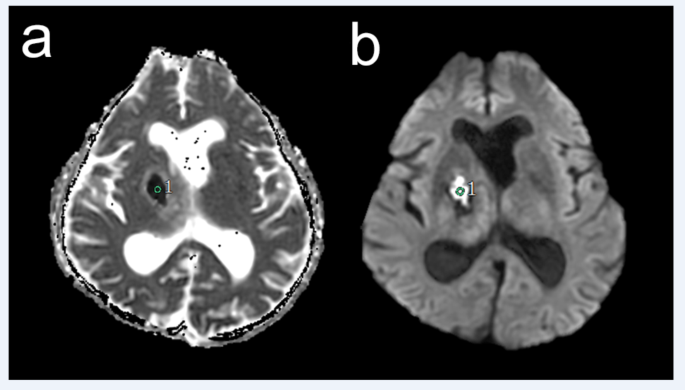Mechanism and significance of diffusion restriction followed by ...