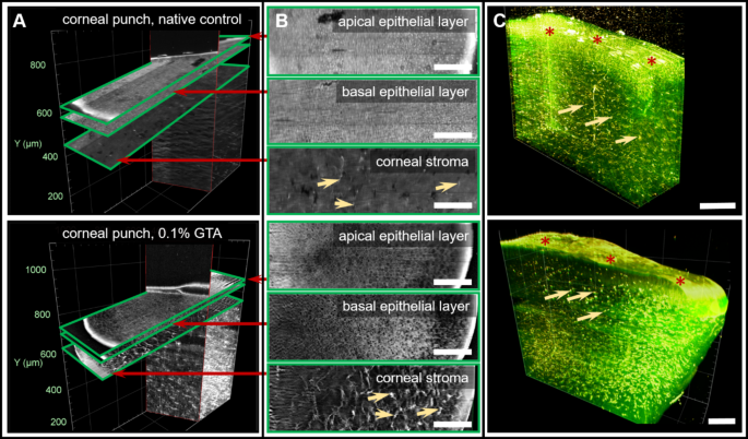 Collagen crosslinking-induced corneal morphological changes: a three ...