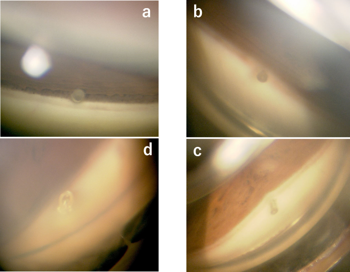 Transient hyphema associated with PRESERFLO® MicroShunt surgery using a ...