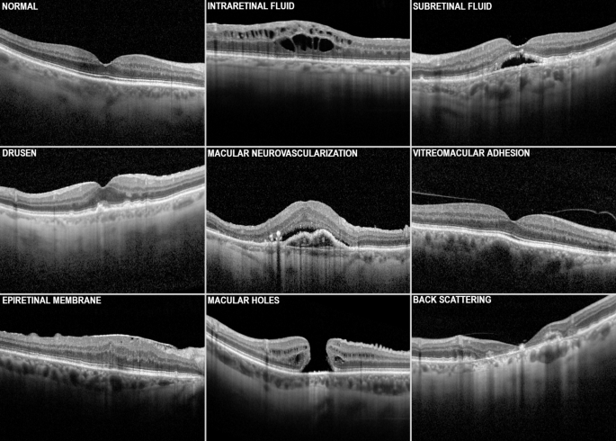 Evaluating deep learning models for classifying OCT images with limited data and noisy labels ...