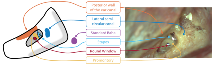 Bone conduction stimulation efficiency at coupling locations closer to ...