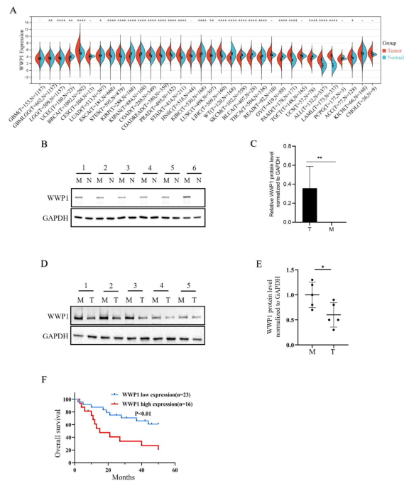 WWP1 targeting PTEN for polyubiquitination to promote bone metastasis ...