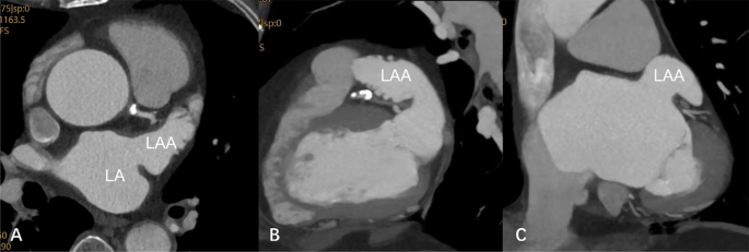 Different scanning protocol to assess left atrial appendage thrombus in patients with atrial ...