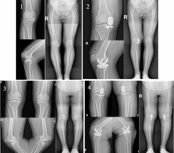 Comparison of clinical outcomes of bilateral and unilateral ...