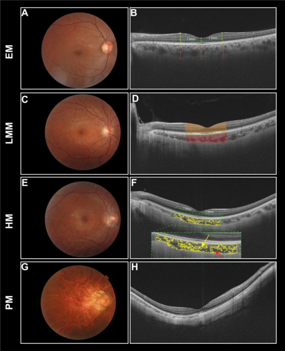 Structural changes in the retina and choroid in patients with different ...