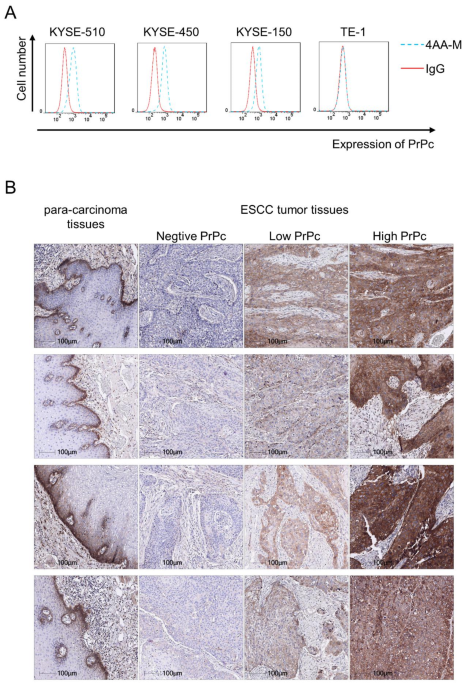 Re-evaluation of the relationship between PrPc expression and patient ...
