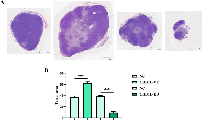 CHD1L accelated the progression of cutaneous squamous cell carcinoma ...