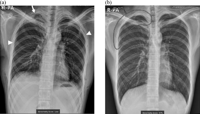 Optimizing adult-oriented artificial intelligence for pediatric chest ...