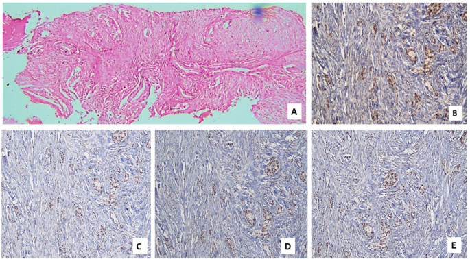 DNA mismatch repair (MMR) genes expression in lung cancer and its ...