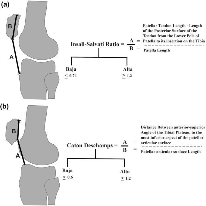 Patella height ratios diagnose the same healthy knees differently ...