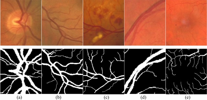 Multi scale multi attention network for blood vessel segmentation in ...