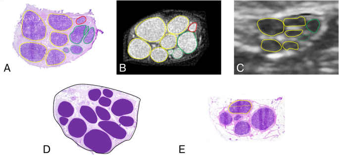 Fascicle differentiation of upper extremity nerves on high-resolution ...