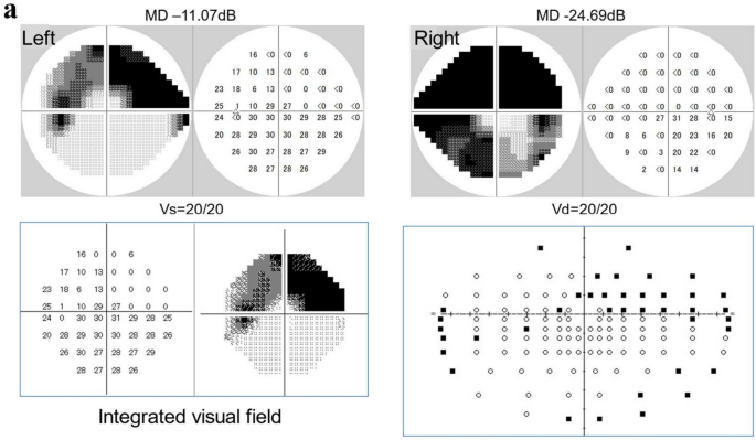 Discrepancy and agreement between subjective symptoms and visual field ...