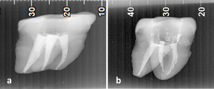 Evaluation and comparison of mandibular molar root canal filling ...