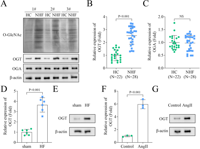 OGT-mediated O-GlcNAc of FOXO1 promotes the progression of neonatal ...
