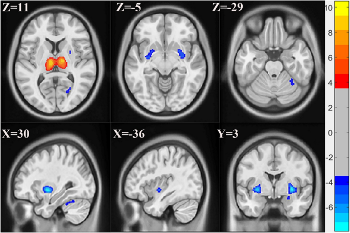 Brain structural differences between fibromyalgia patients and healthy ...