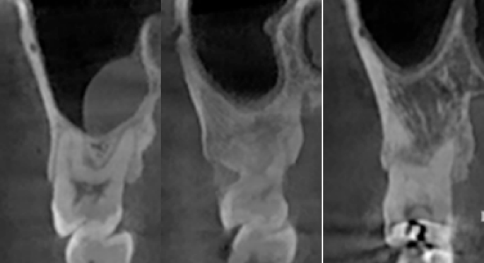 Construction of the risk prediction model of the alveolar antral artery ...