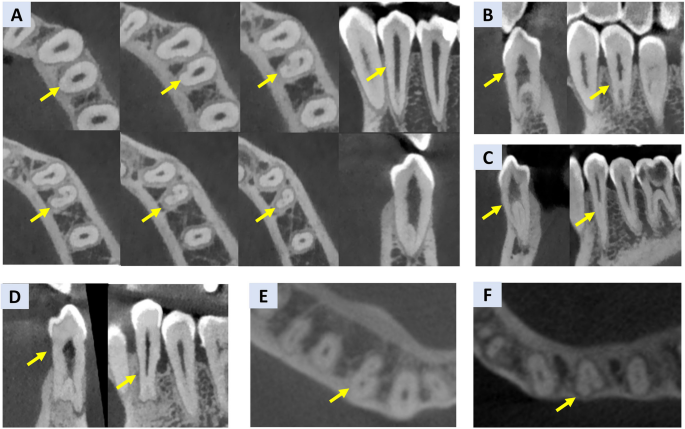 Multinational cross-sectional study and meta-analysis on radicular ...