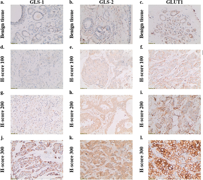 Clinicopathological analysis of GLUT-1, GLS1, and GLS2 expression in breast cancer tissues from ...