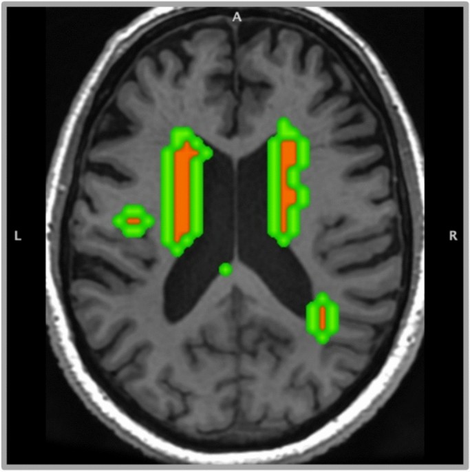 Microstructural and microvascular features of white matter hyperintensities and their ...