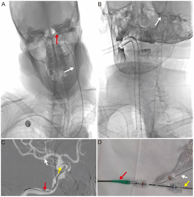 Feasibility and safety of 0.018-inch guidewire-supported distal access ...