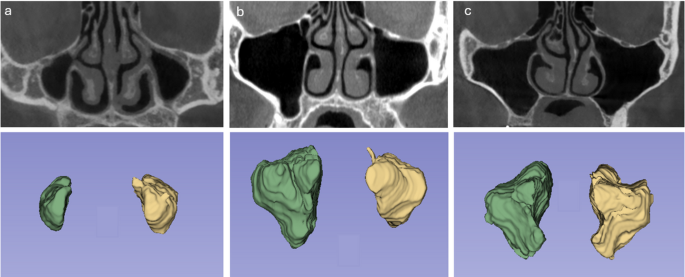 Three-dimensional CBCT analysis of how sinonasal variations affect maxillary sinus volume in ...