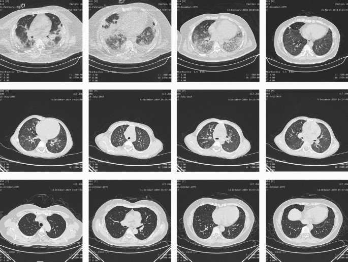 Multimodal text guided network for chest CT pneumonia classification ...
