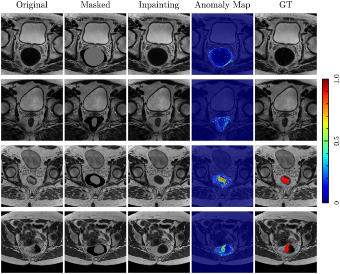 Improving rectal tumor segmentation with anomaly fusion derived from ...