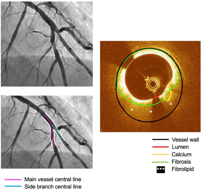 Computational simulations of coronary artery bifurcation stenting using realistic plaque ...