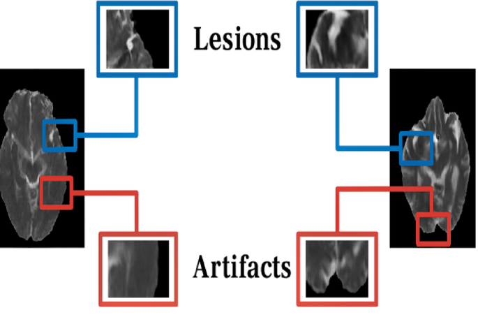 Automated deep U-Net model for ischemic stroke lesion segmentation in the sub-acute phase ...