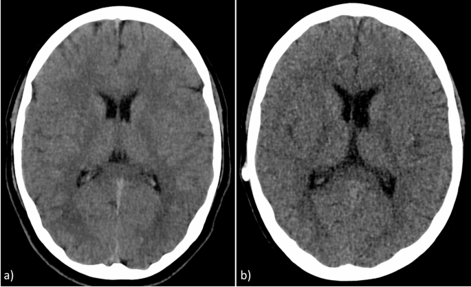Radiation dose optimisation in paediatric head CT using attenuation ...