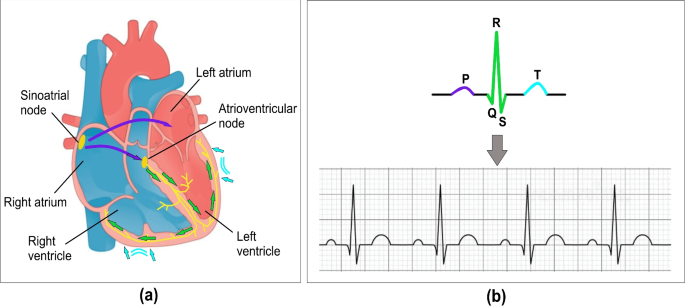 An integrated algorithm for single lead electrocardiogram signal ...