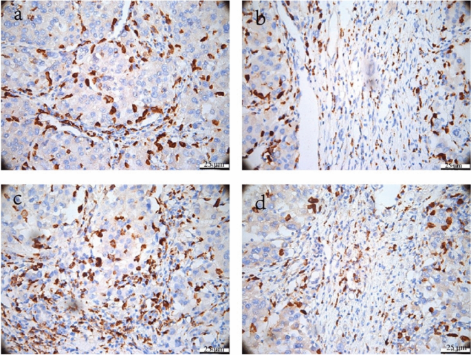 CD68- and CD163-positive tumor-associated macrophages in renal clear ...