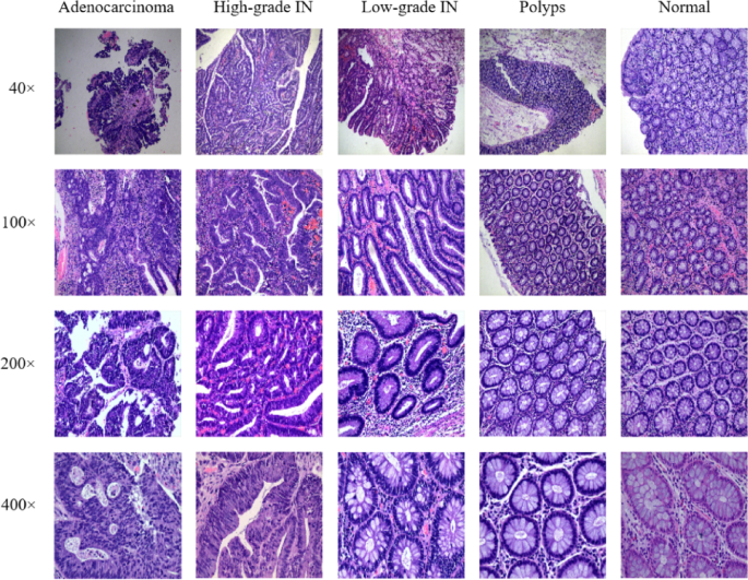 Histopathological classification of colorectal cancer based on domain ...