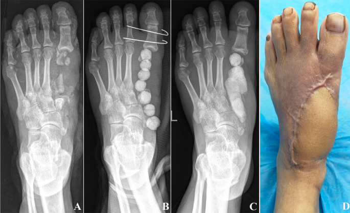 Clinical application research on the titanium metal metatarsal ...